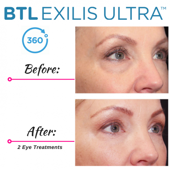 Arcbőrfeszesítés BTL Exilis Ultra géppel - Hertelendy Aesthetica